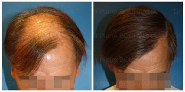 Que sont les Injections PRP cheveux ? | Ilajak médical