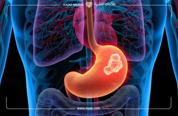Opération du cancer de l'estomac | Ilajak médical