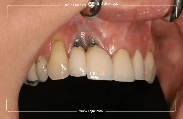Dental Implant Failure: signs, causes, and treatment | ILAJAK Medical