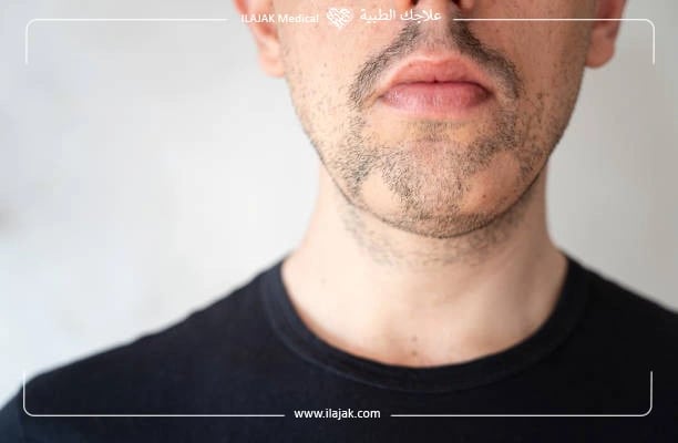 Beard Hair Loss: Causes & treatment | ILAJAK Medical