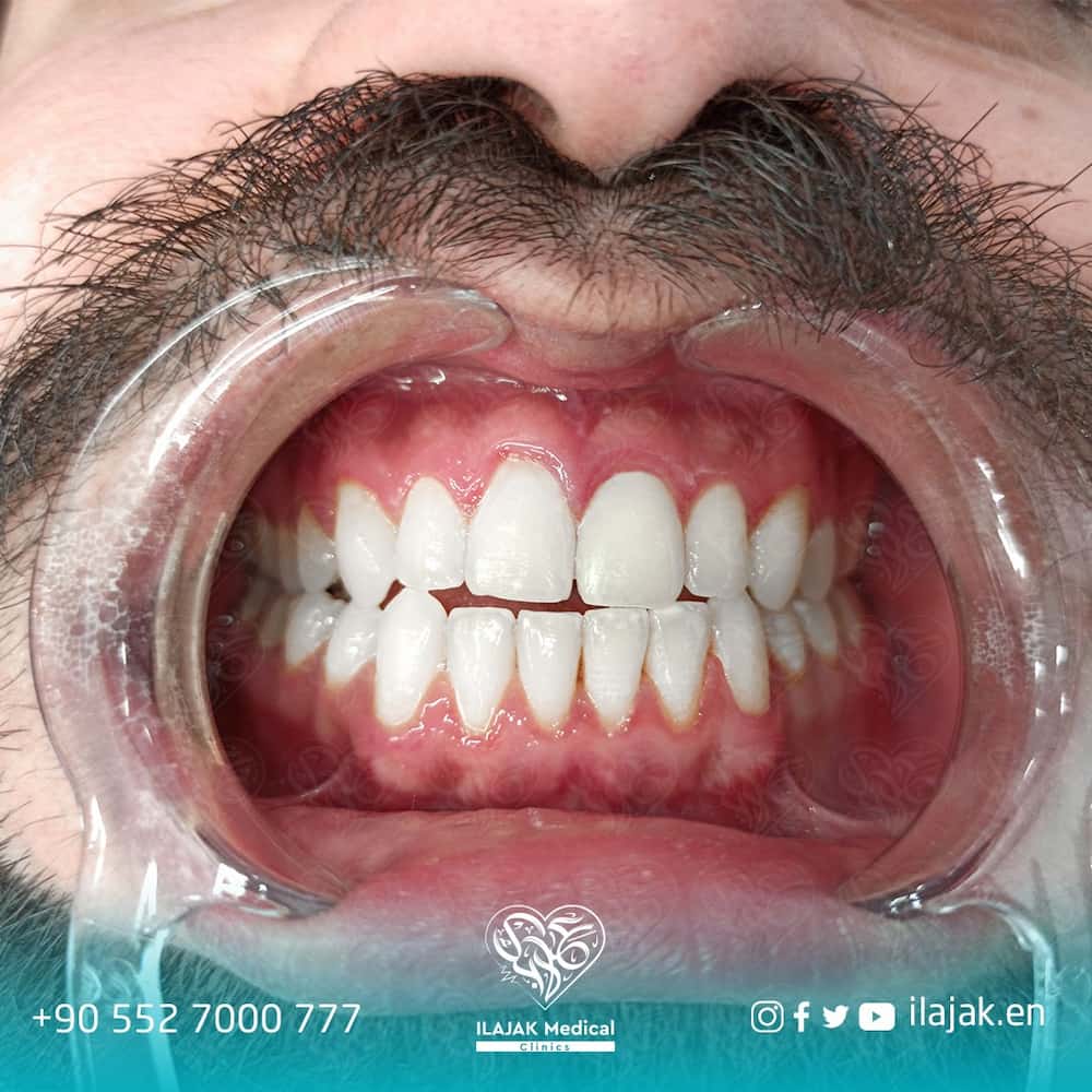 Cavity on front tooth: Why do we get it? | ILAJAK Medical