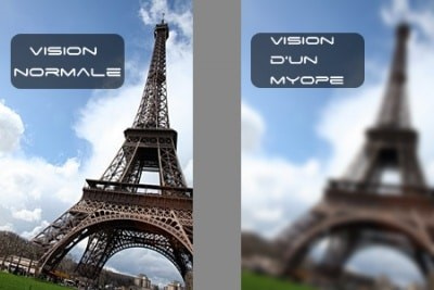La myopie : types, causes et traitements | Ilajak médical