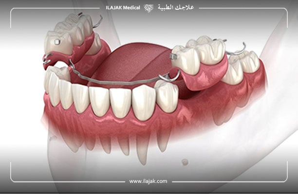 Prothèse dentaire amovible : le guide complet | Ilajak médical